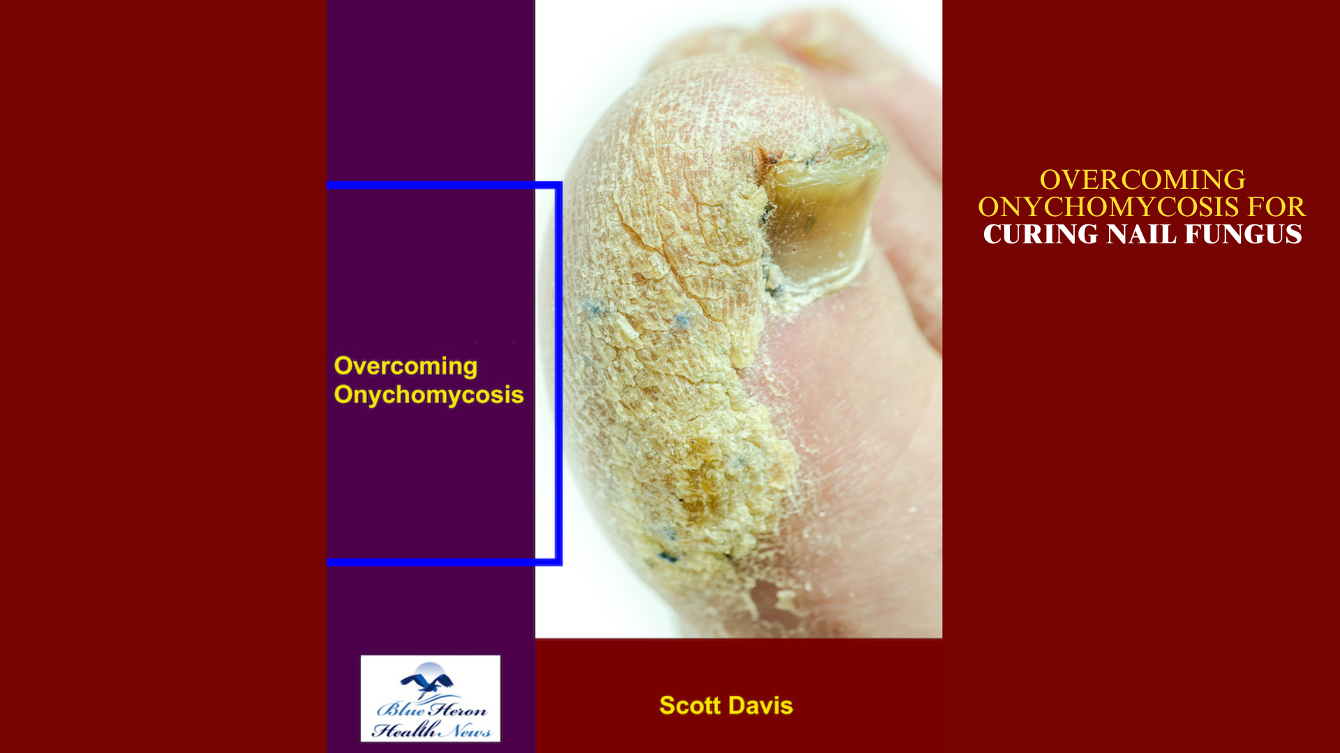Overcoming Onychomycosis For Curing Nail Fungus Infection