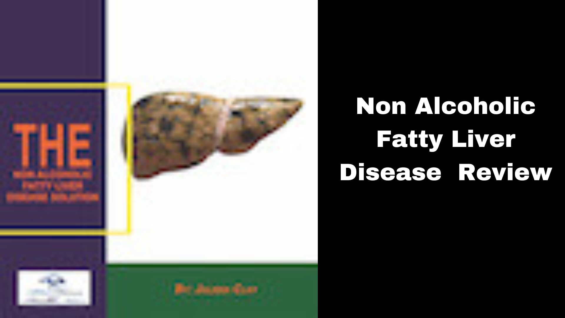 Non Alcoholic Fatty Liver Disease Review-Diagnosis and Treatment